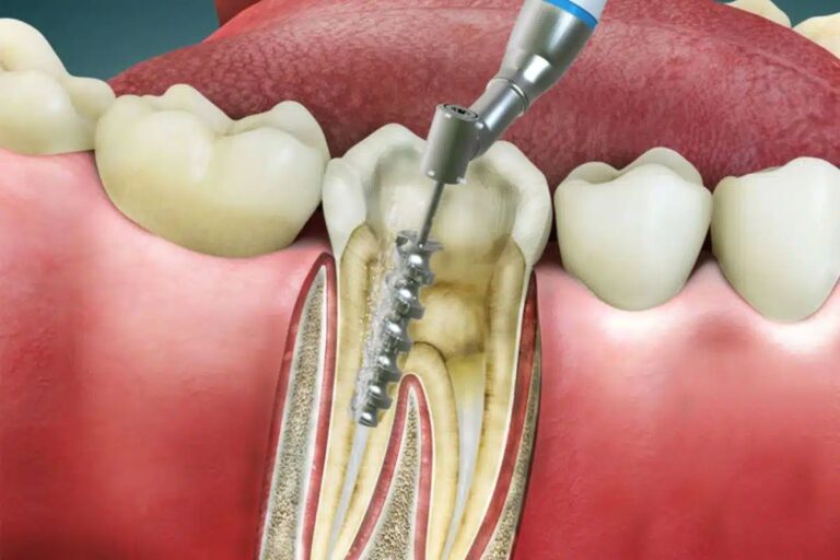 What Exactly Is Done During a Root Canal? - Westpark Village Dental ...